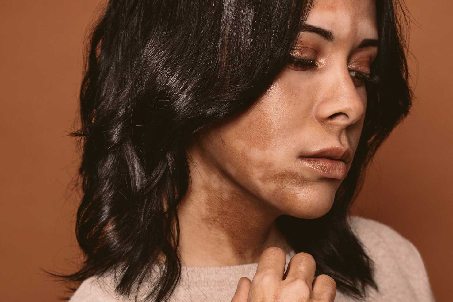 Ayurvedic Solution For 5 Common Skin Problems